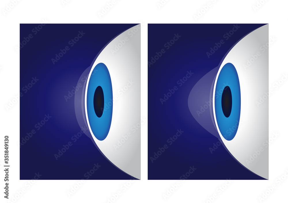 Poster eye cornea and keratoconus vector / anatomy – Wall Art | UkPosters