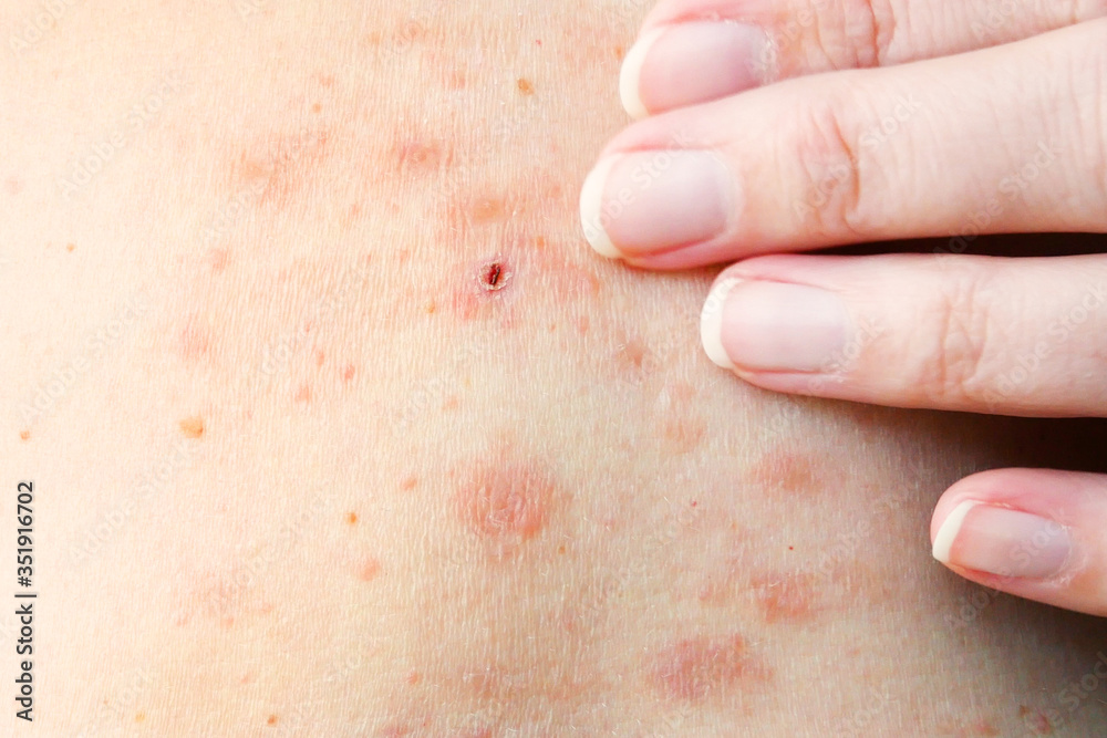 skin rash treatment on woman body. Shingles, Disease, Herpes zoster ...