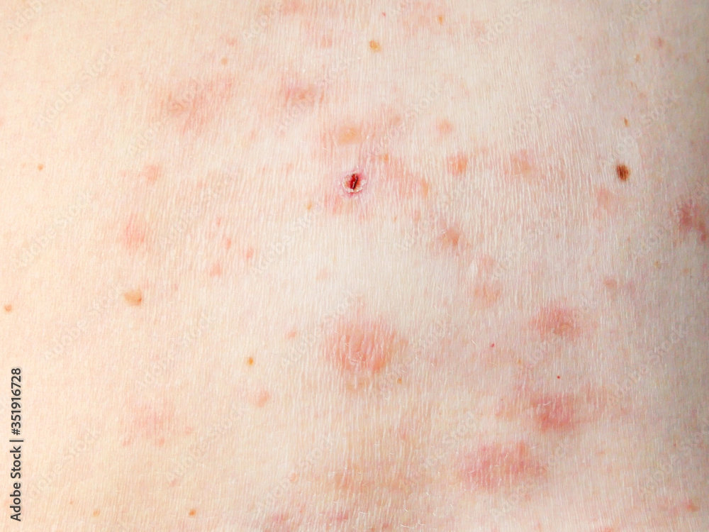Foto de skin rash treatment on woman body. Shingles, Disease, Herpes ...