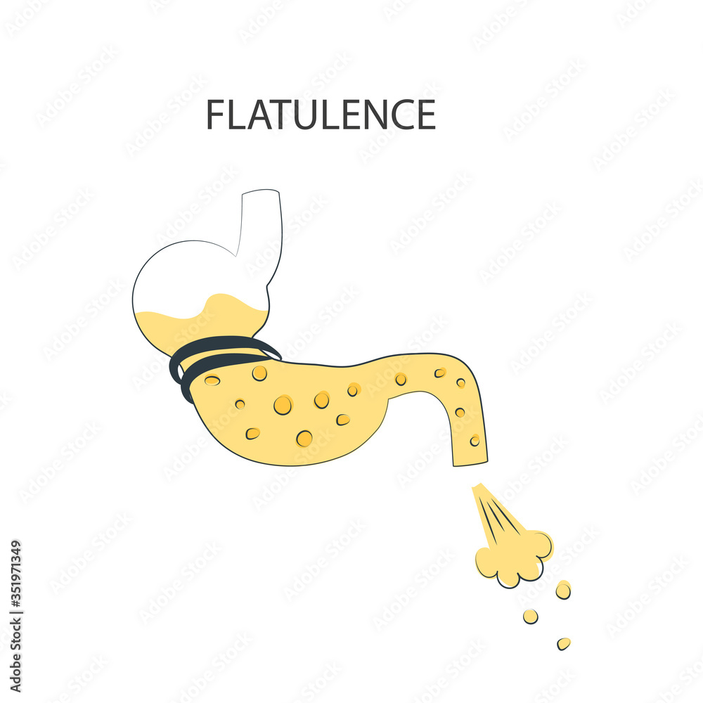 Vetor de Medical banner for flatulence. Formation of gases in the ...