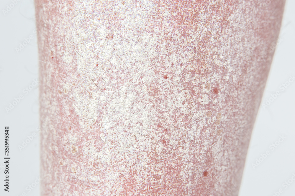 Close up acute psoriasis on male legs is an autoimmune incurable ...