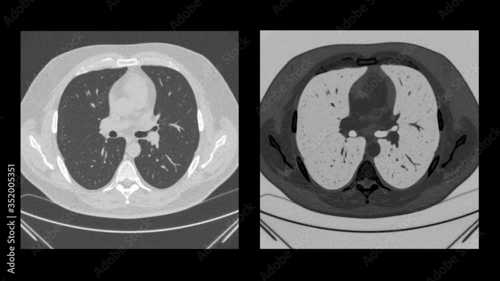 Chest ct scan, Radiological computed tomography of the lungs for ...