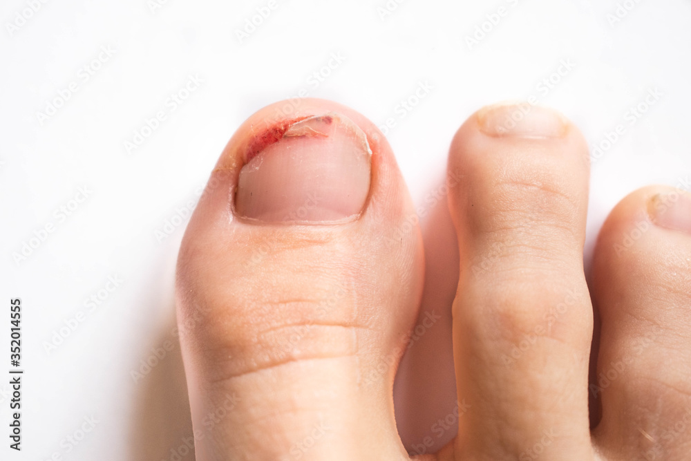 Toenail on big toe partially torn off from the nail bed due to blunt ...