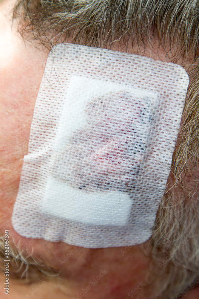 Dressing on wound on face after removal of melanoma in situ by plastic ...