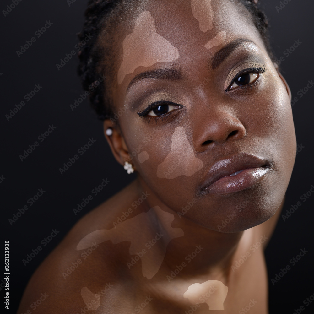 Vitiligo Model