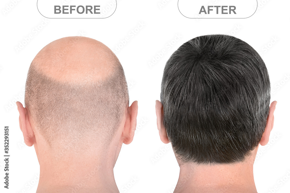 Back view of male head before and after hair extensions Stock Photo ...