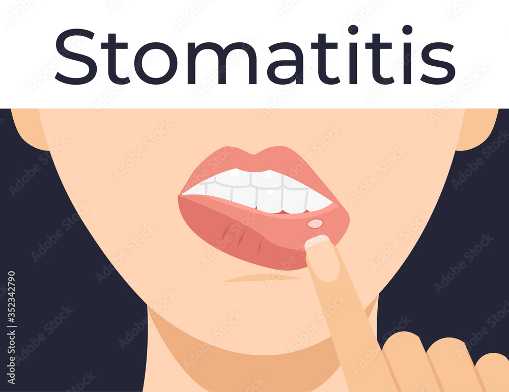 Stomatitis. Woman has inflammation of the mouth and lips. Flat vector ...
