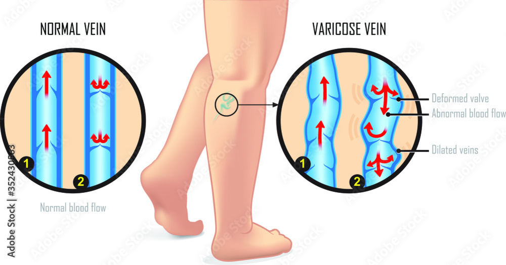 Vector illustration of normal vein and varicose vein anatomy Stock ...