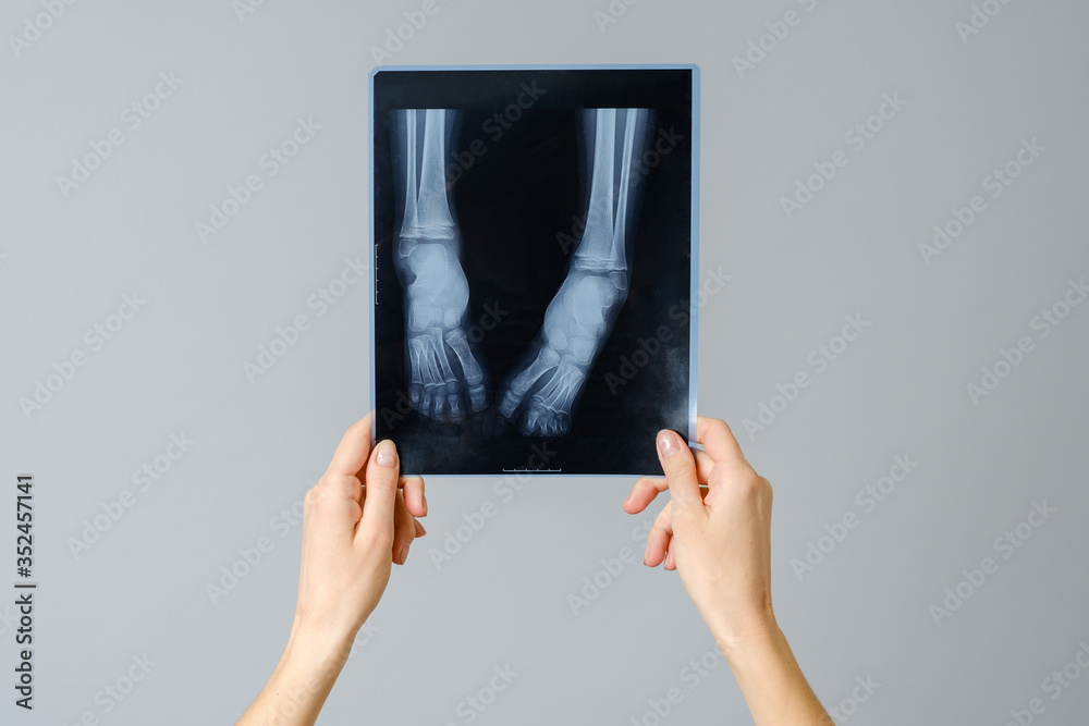 Female doctor examining x-ray image of legs of newborn baby Stock Photo ...