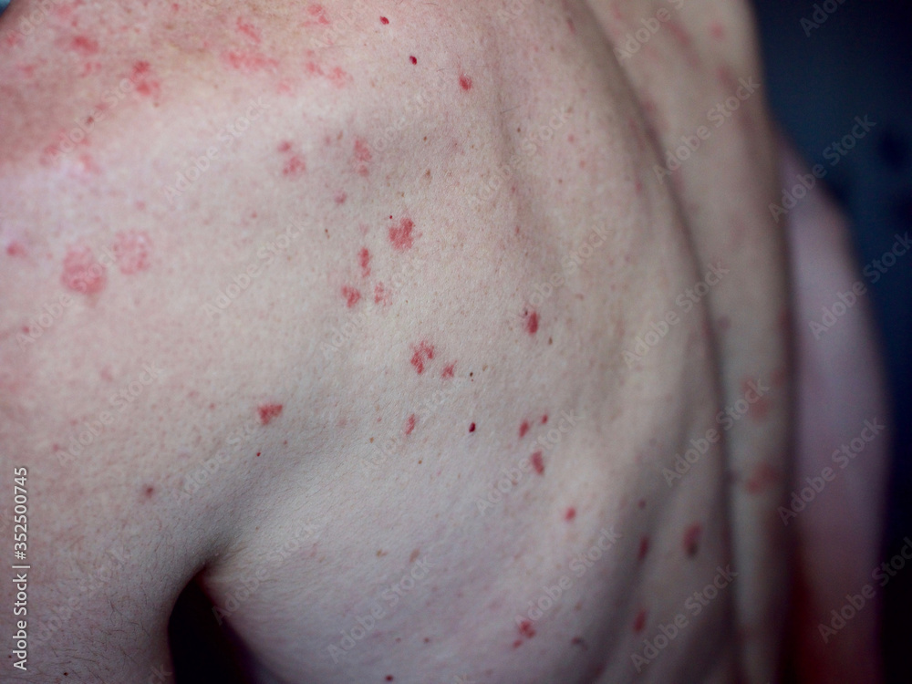 CLOSE UP: An unrecognized man suffering from an autoimmune incurable ...