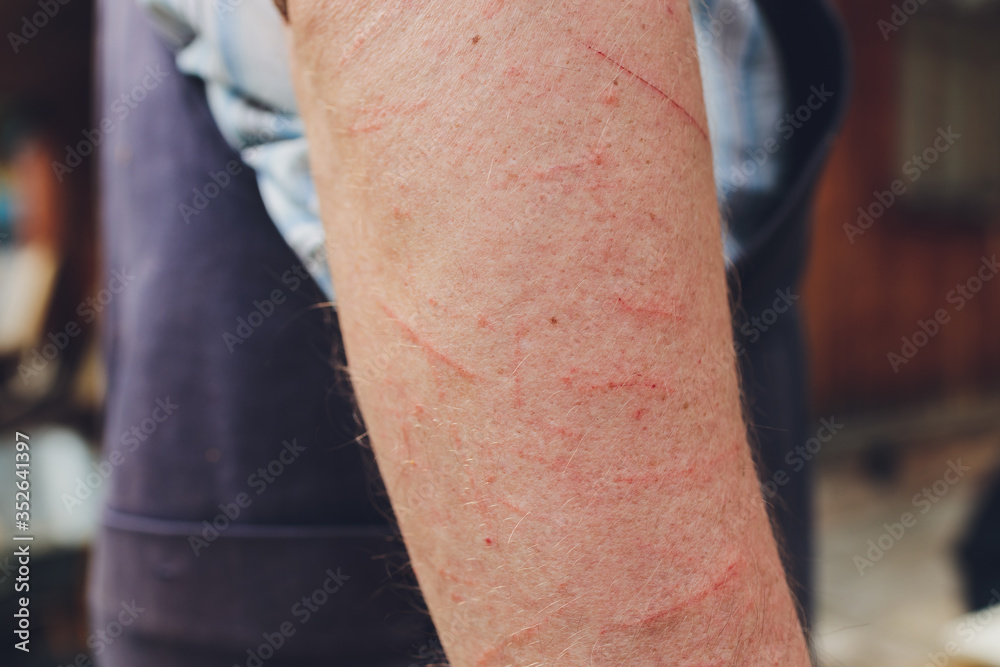 Skin allergy diseases problem, Poison tree contact dermatitis rash by ...