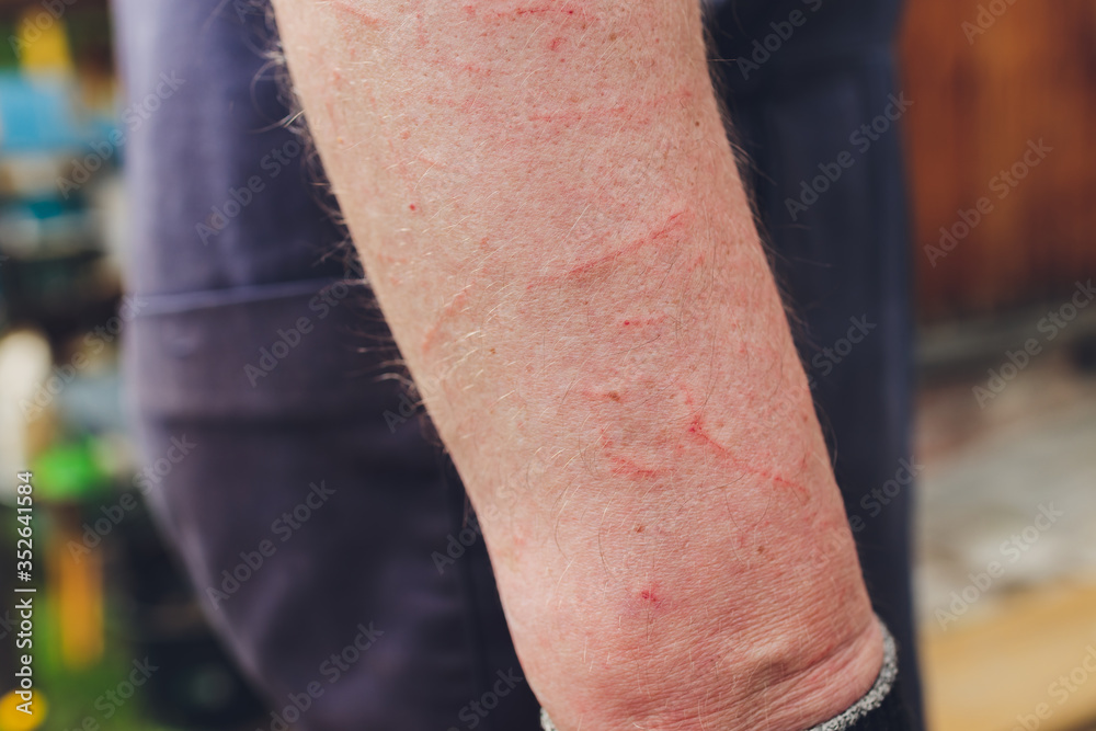 Skin allergy diseases problem, Poison tree contact dermatitis rash by ...