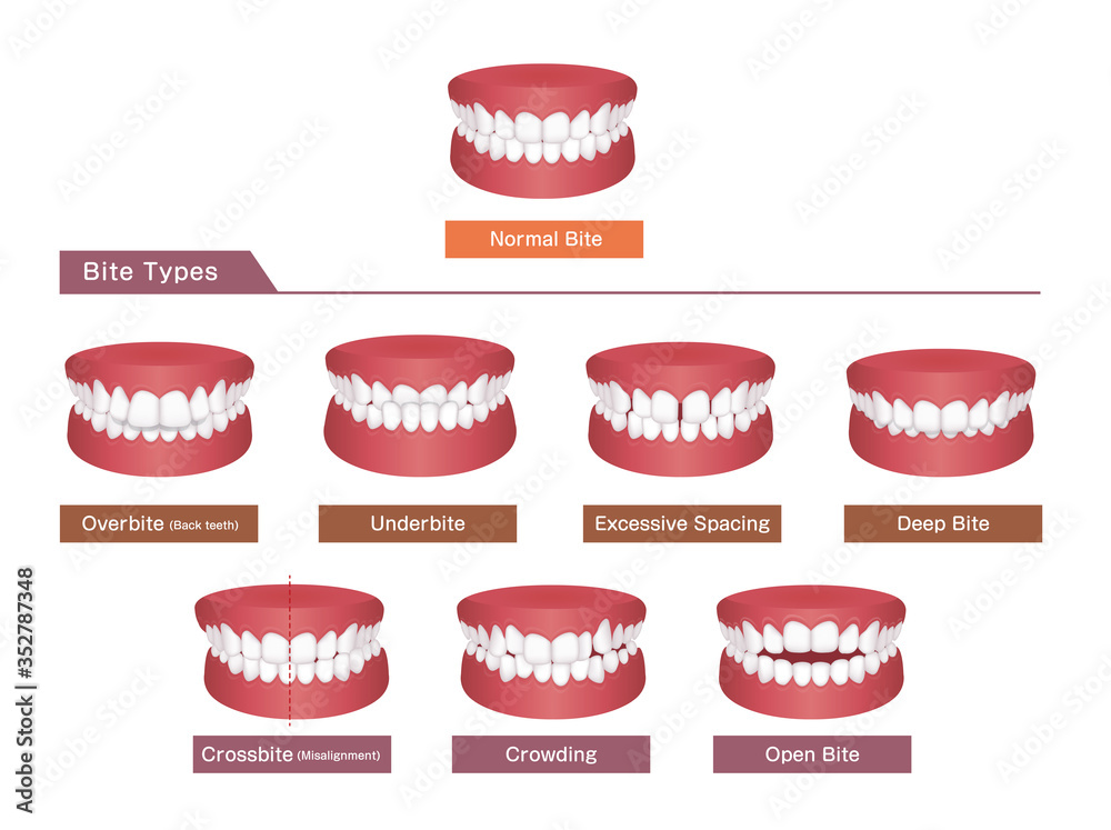 Teeth trouble ( bite type ) vector illustration set Stock Vector ...