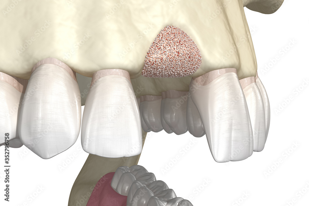 Augmentation Surgery - Adding bone after tooth extraction. 3D ...
