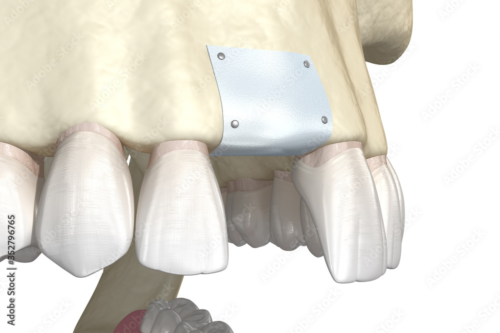 Augmentation Surgery - Adding bone after tooth extraction. 3D ...
