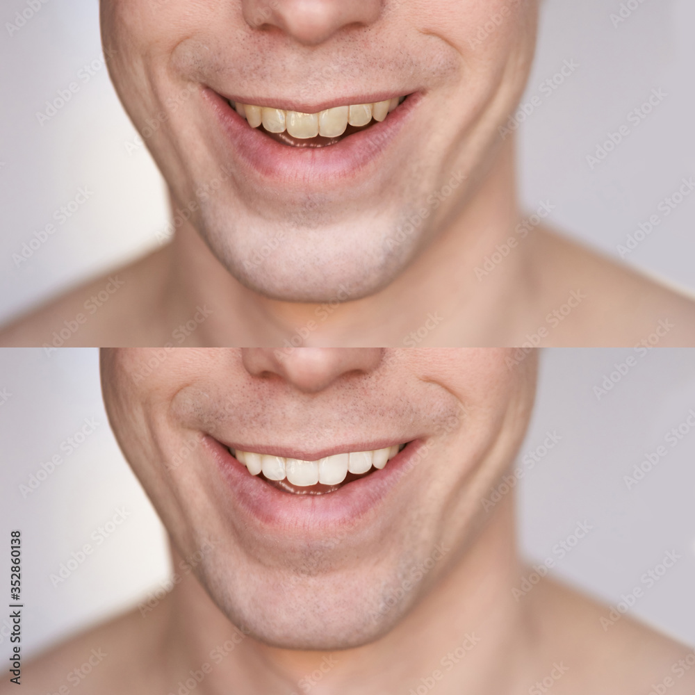 Men smile. Male smiling person. Whitening oral care concept. Teeth ...