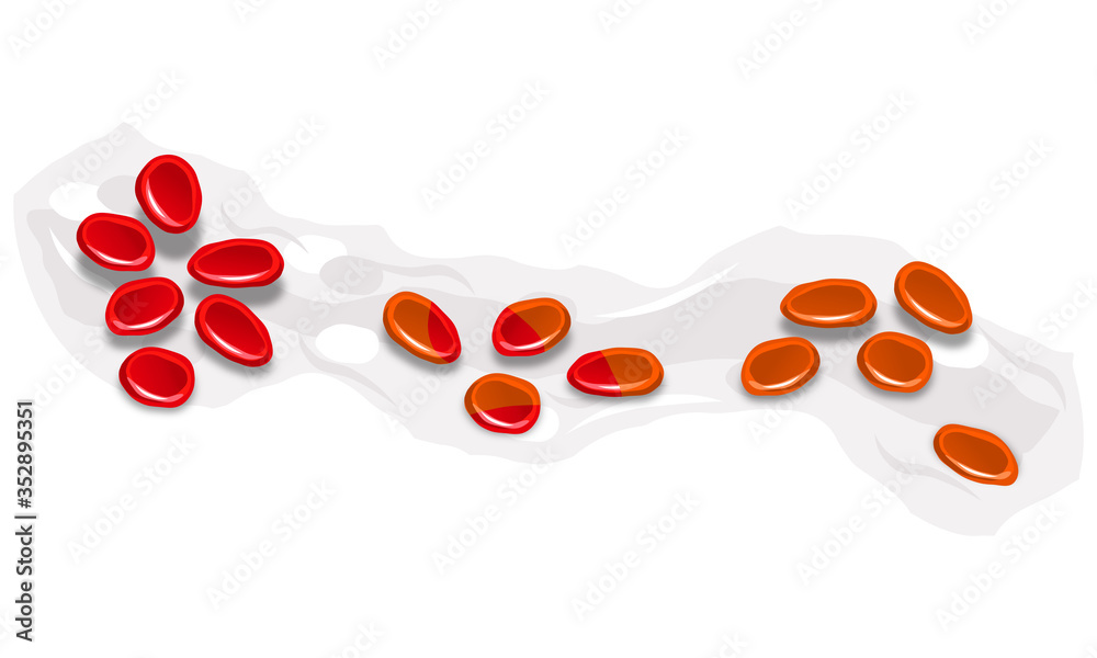 Blood plasma view. Red cells become yellow (hyperuricemia) Stock Photo ...