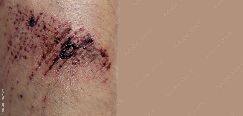Wound injury on guy leg with brown background. Wound form scabs. Wound ...