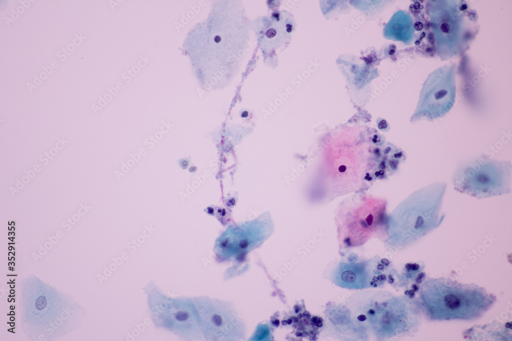 View in microscopic of Candidiasis, fungus infection (Yeast and ...