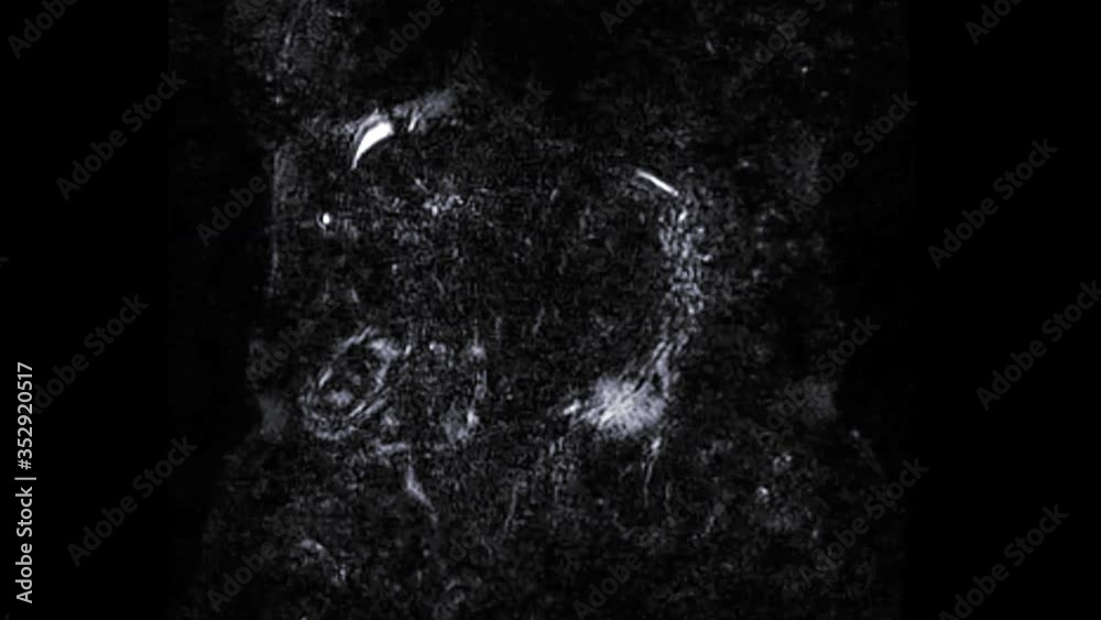 Magnetic resonance cholangiopancreatography or MRCP 3D Coronal MIP view ...