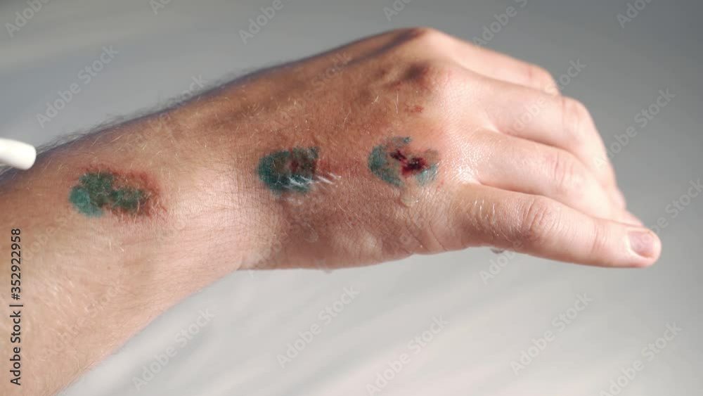 cleaning infected wound on arm Stock ビデオ | Adobe Stock