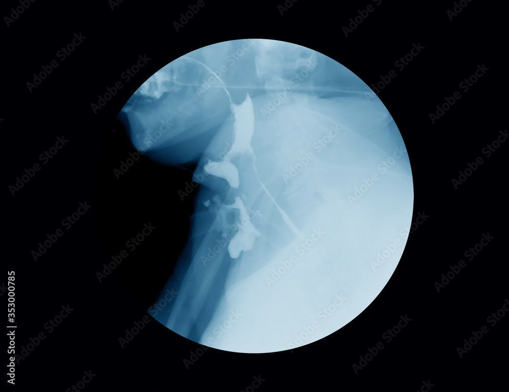 X-ray image of Barium meal examination ( or Barium swallow, Upper ...