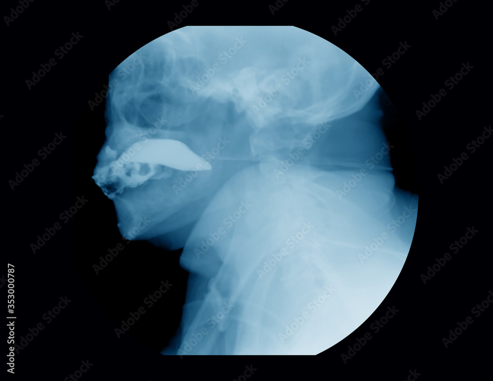 X-ray image of Barium meal examination ( or Barium swallow, Upper ...