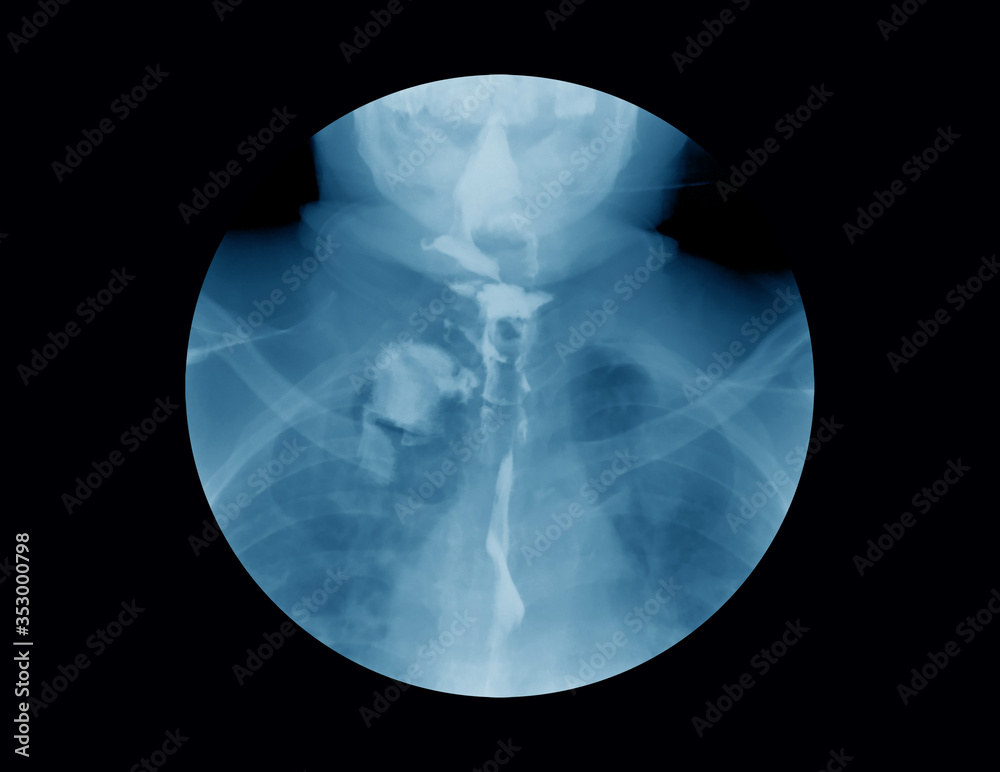 X-ray image of Barium meal examination ( or Barium swallow, Upper ...