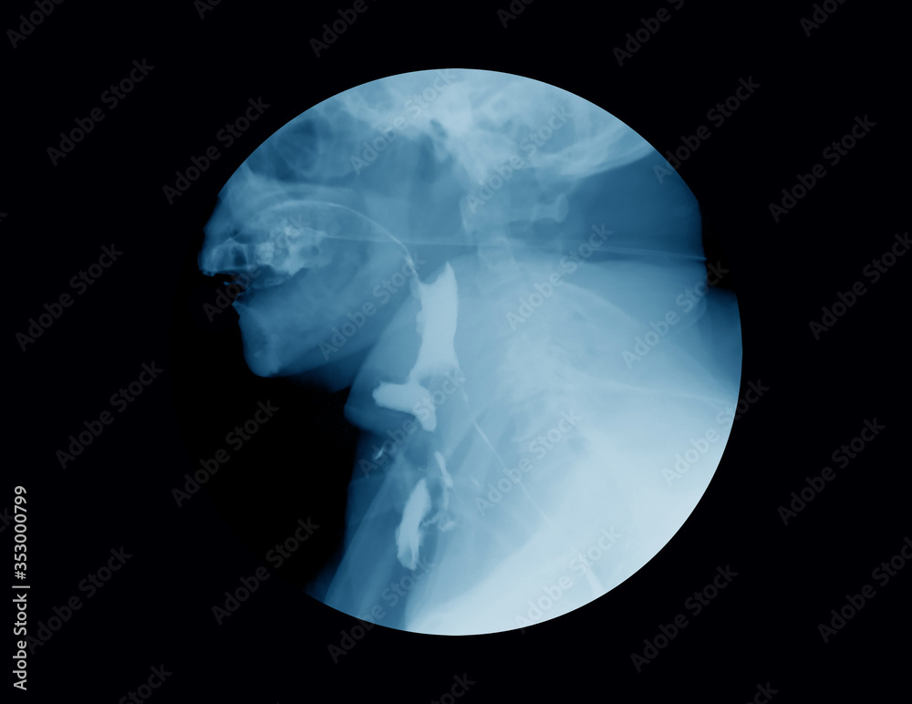 X-ray image of Barium meal examination ( or Barium swallow, Upper ...