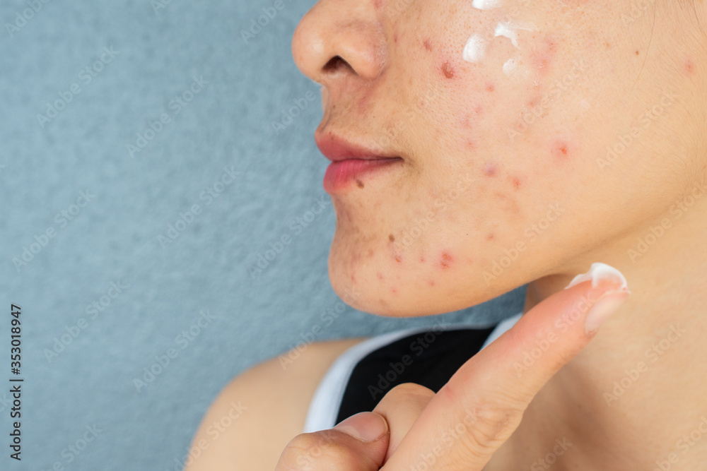 Cropped shot of woman half face with acne inflammation (Papule and ...