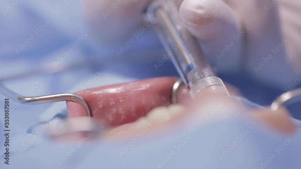 Anesthesia For Gum Surgery at Linda Aucoin blog