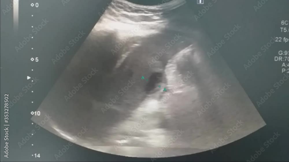 Whole abdomen ultrasound wave scan show image of kidney human for ...