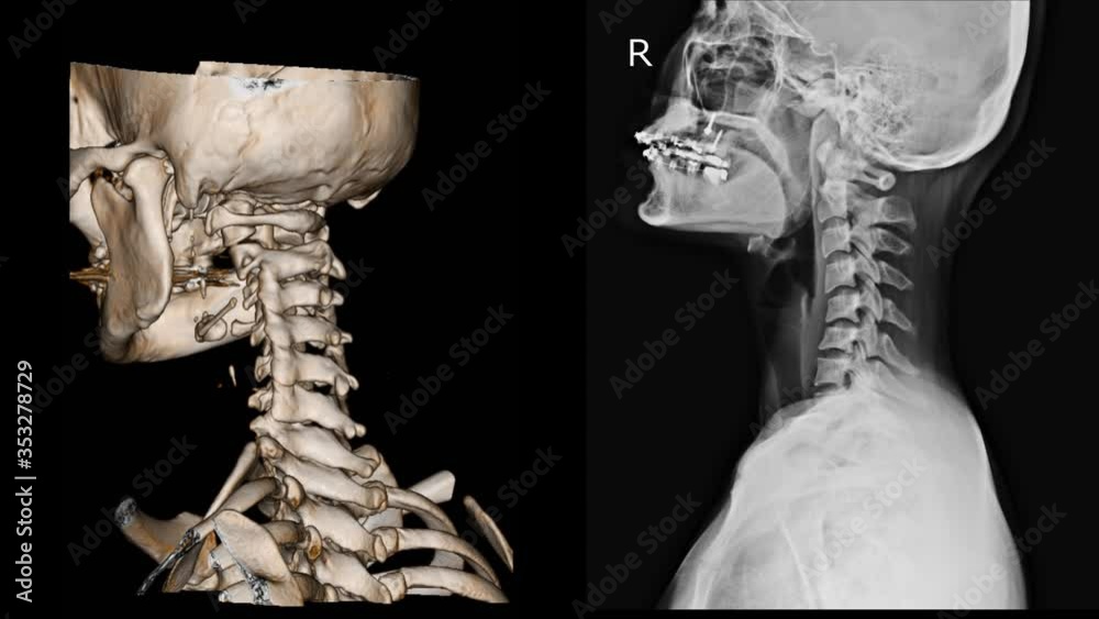 CT Scan cervical spine 3 D render and X-ray C-spine finding Reverse ...