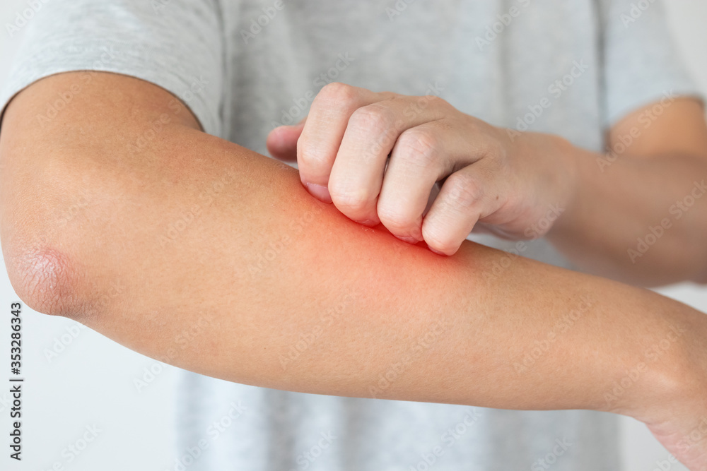 Young asian man itching and scratching on arm from itchy dry skin ...