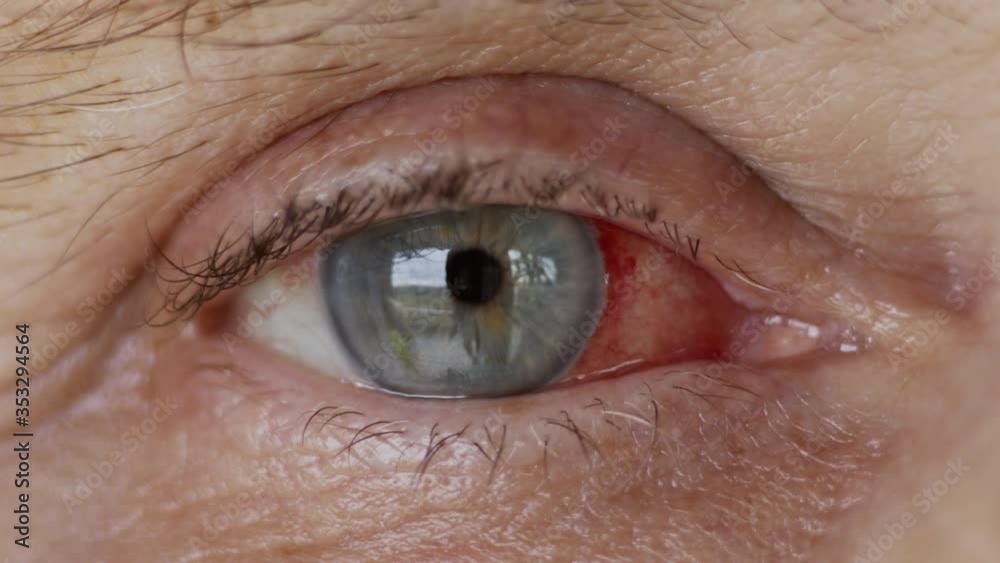 Red eye caused by operation of the day before. Surgical inflammation ...