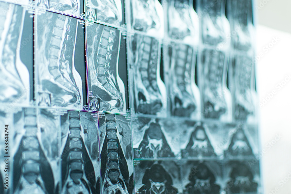MRI of the spine. X-ray of the back to the lumen. Medical business ...