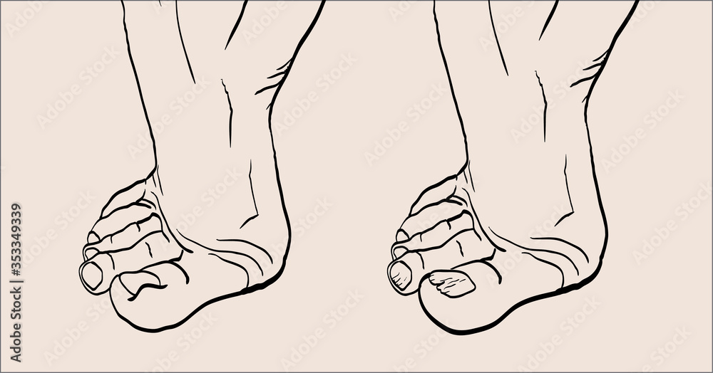 foot drawn with podiatry problems. Fingers and nails to be restored for ...