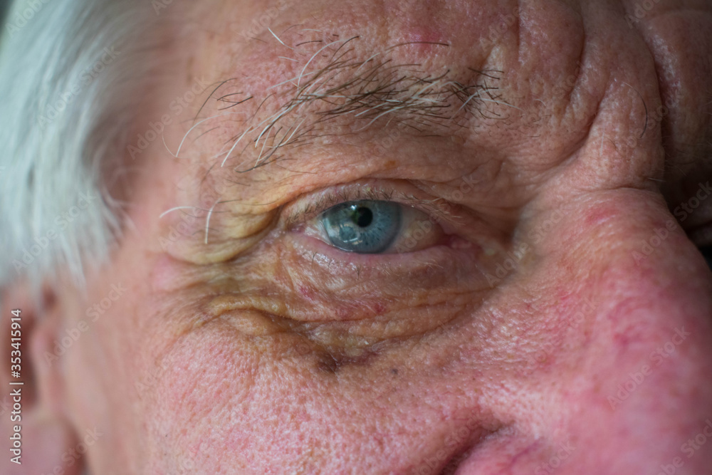 Macro image of an old man with a black and yellow bruised eye socket ...