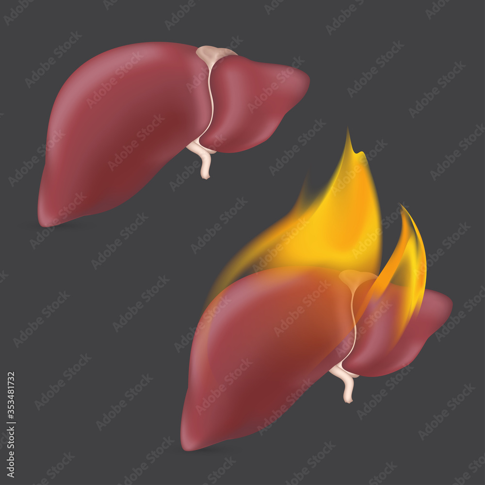 Burning anatomical liver. Realistic human organ of internal digestion ...