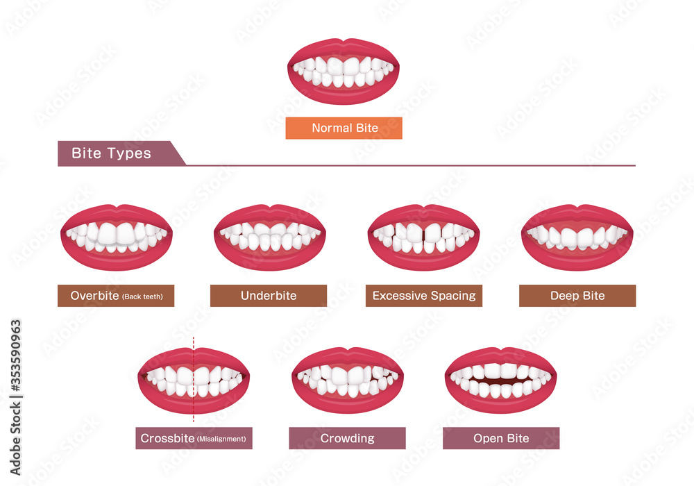 Teeth trouble ( bite type / crooked teeth ) vector illustration set ...