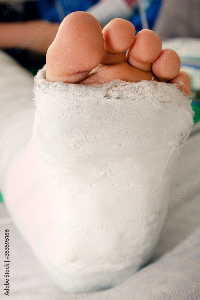 Detail of the left leg or foot in white plaster.Broken leg in plaster ...