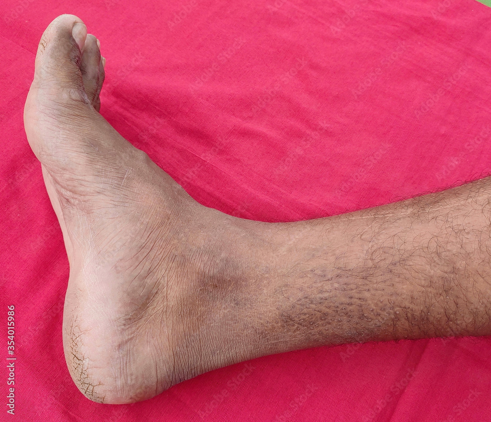 Chronic skin disease on leg looks like rash or pimples. Also itching at ...