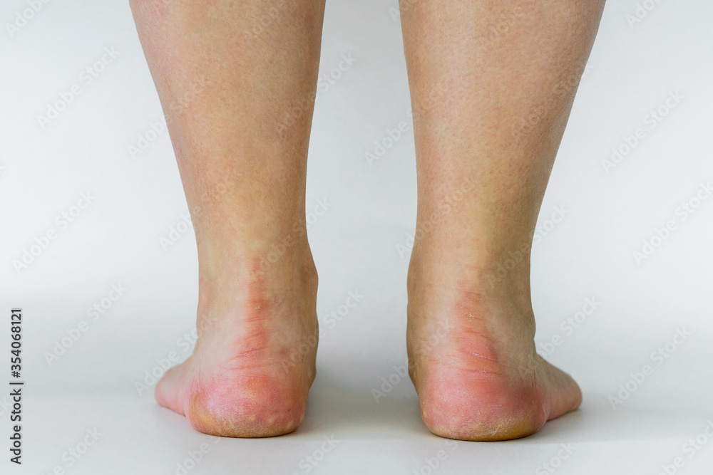 Flatfoot with dry cracked heel with piezogenic pedal papules on woman ...