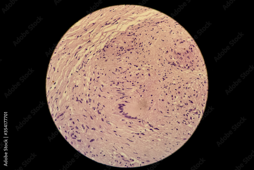 Langerhans cells (LC) are members of the dendritic cells family ...