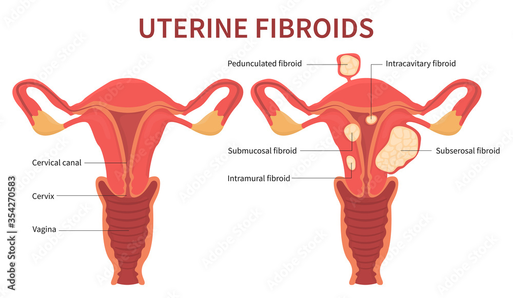 Isolated Flat Vector Illustration Of Uterine Fibroids Myoma Uterine
