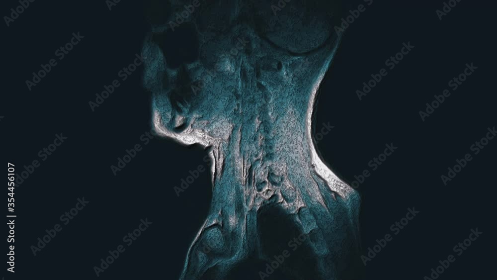 Voluminous color MRI of the cervical spine, detection of protrusions ...