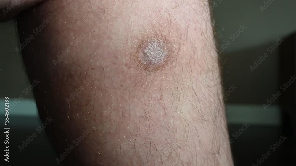 MRSA infection scar one year after large infection on the leg, super ...