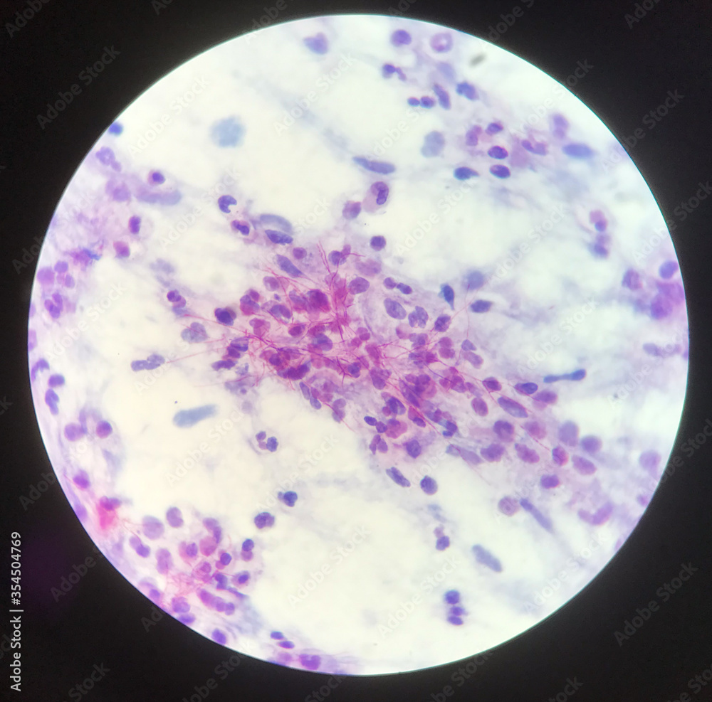 Red branching mycobacterium tuberculosis on blue background in modified ...