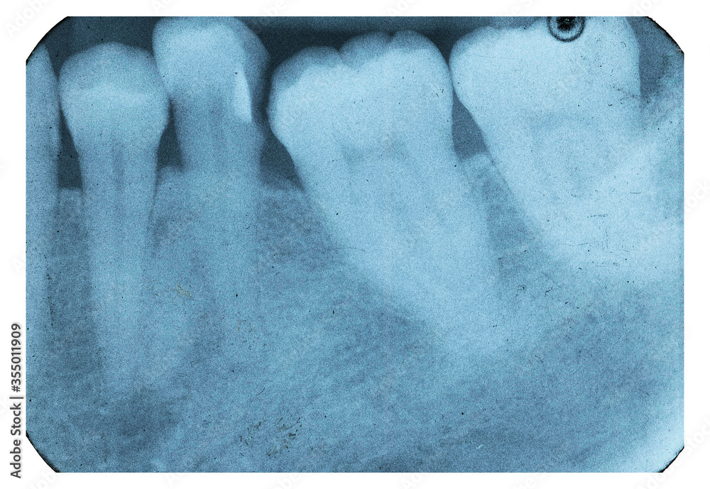 x-rays of a dental fillings Stock Photo | Adobe Stock