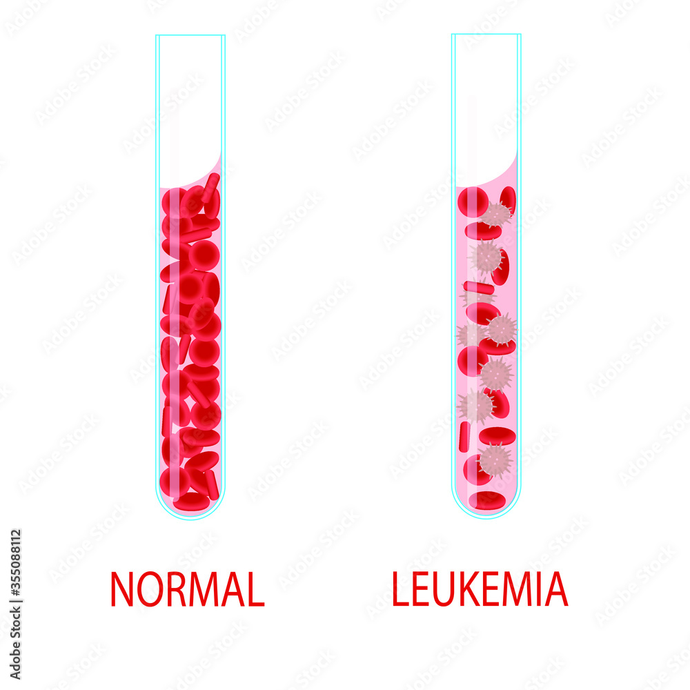 Leukemia. Vector illustration of normal blood and blood of a patient ...